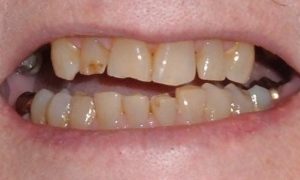Ceramic Tooth-Colored Crowns | Poudre Valley Family Dental